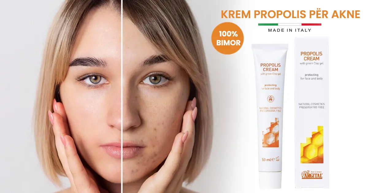 Krem për akne: Si ti largojm aknet njëher e përgjithmonë